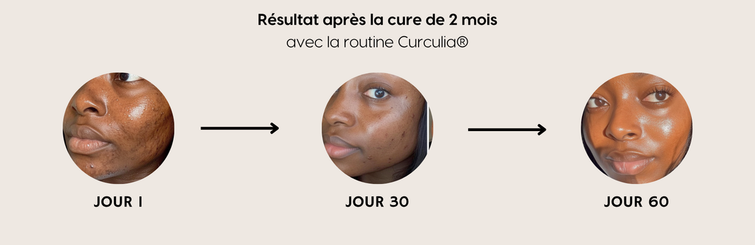 Routine Anti-Imperfections 4 en 1 – Curculia