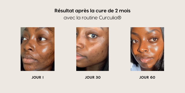 Routine Anti-Imperfections 4 en 1 – Curculia