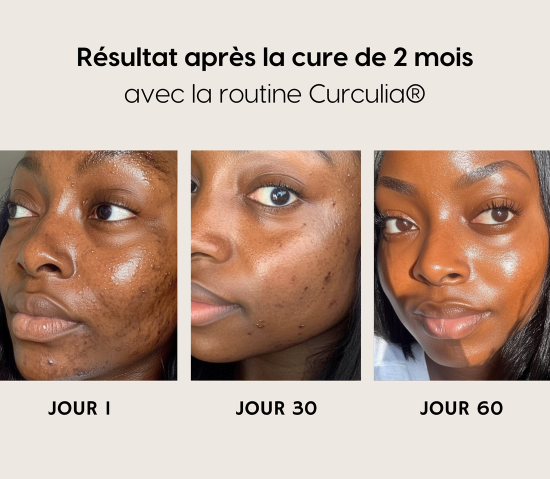 Routine Anti-Imperfections 4 en 1 – Curculia